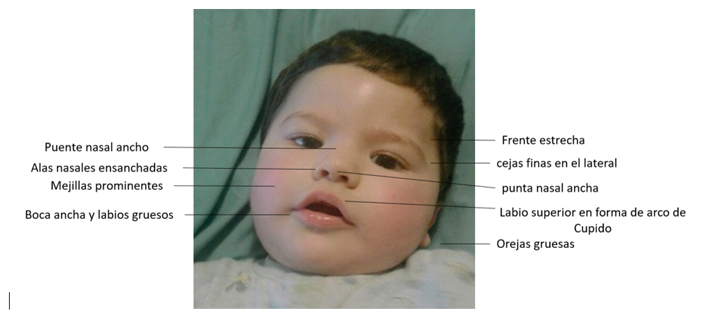 Síndrome de Pitt-Hopkins | Familia y Salud