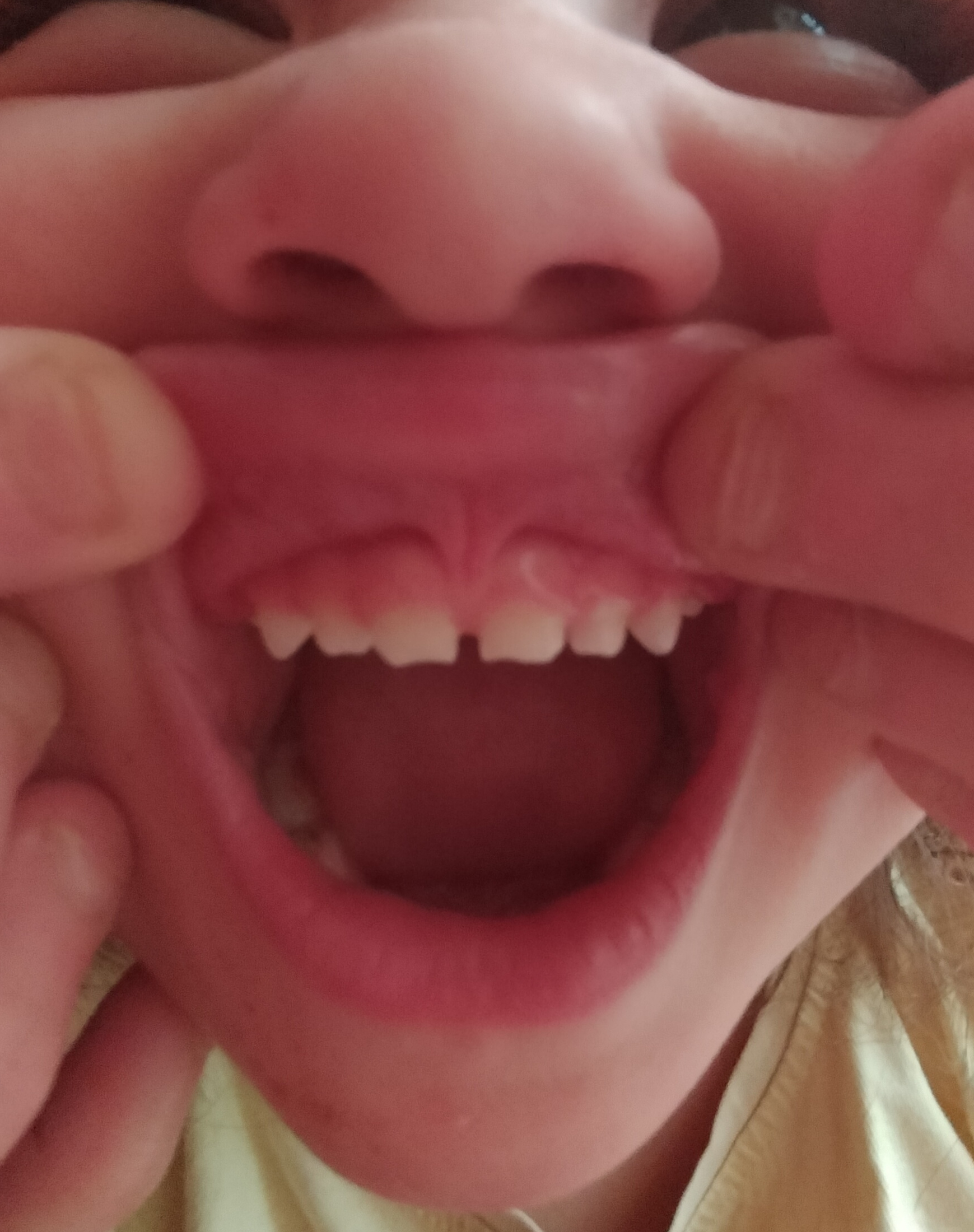 El frenillo labial, ¿da problemas? | Familia y Salud