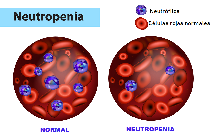 ¿Qué es una neutropenia? | Familia y Salud