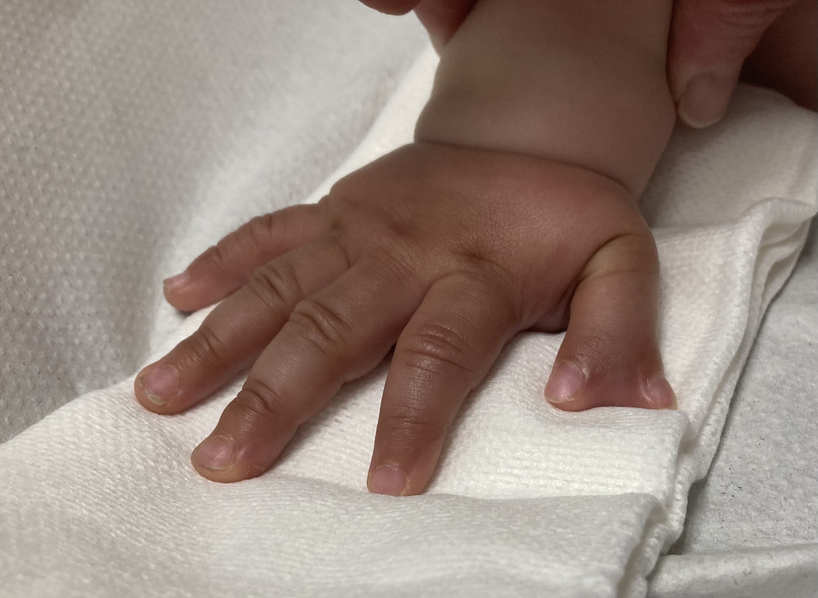 Mi hijo ha nacido con un dedo de más, ¿me preocupo? | Familia y Salud