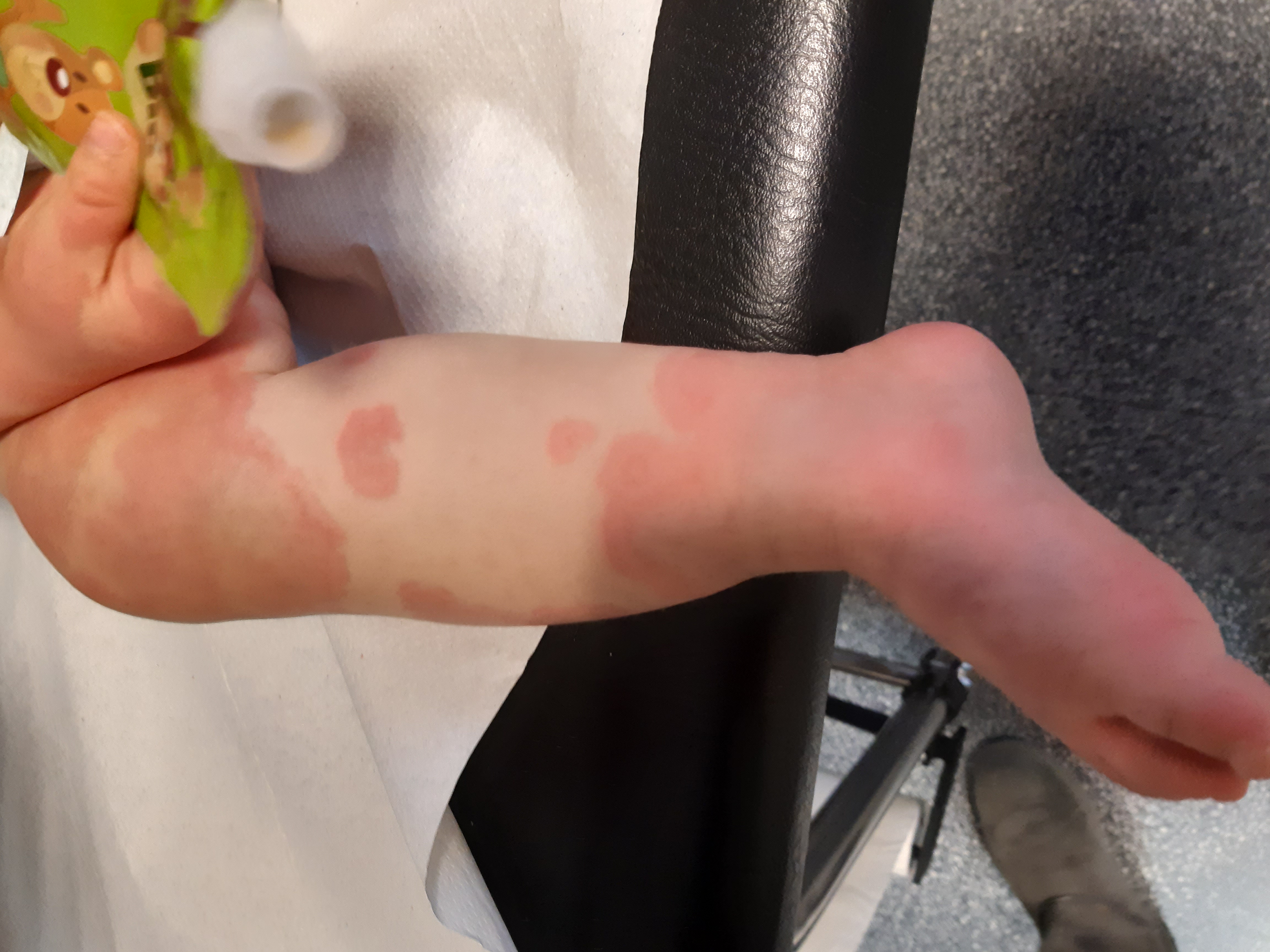 Edema agudo hemorrágico del lactante. ¿Qué son las manchas rojas que ...