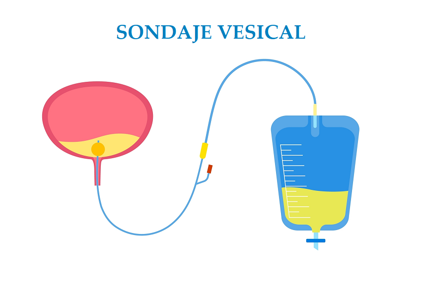 ¿Cuándo se hace un sondaje vesical? | Familia y Salud