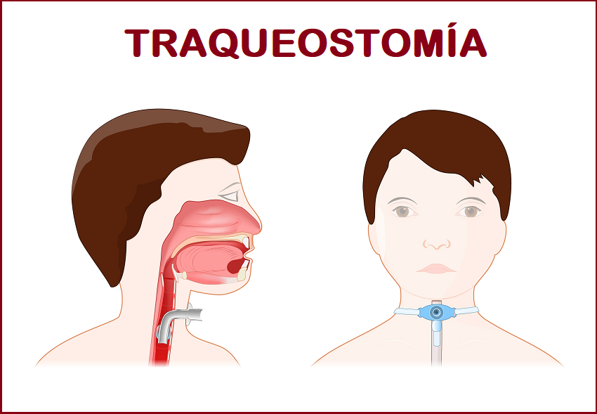 Traqueomalacia Traqueostomia