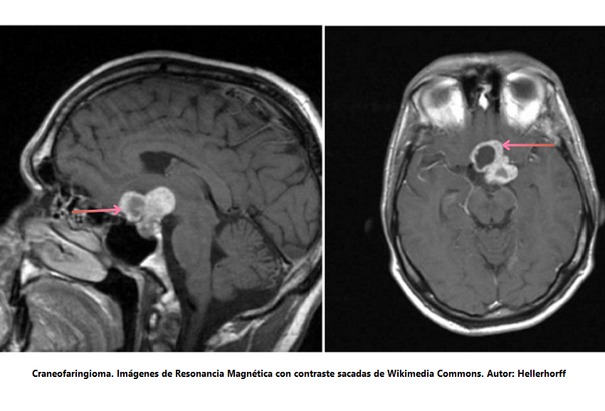 Craneofaringioma: un tumor cerebral | Familia y Salud