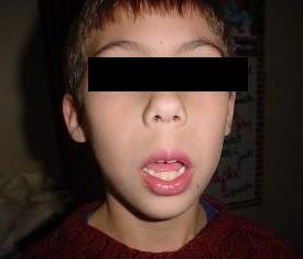 Hipertrofia adenoidea: vegetaciones | Familia y Salud