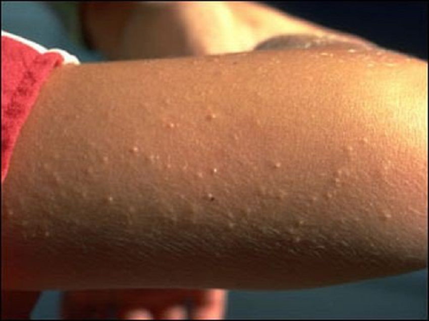 Queratosis pilar | Familia y Salud