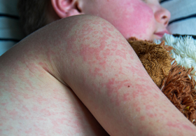 Exantemas por virus en la infancia. ¿Qué son? | Familia y Salud