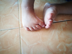 Deformidades de los pies | Familia y Salud