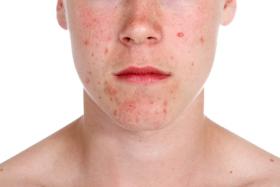 El acné | Familia y Salud
