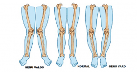 Genu varo y genu valgo | Familia y Salud