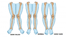genu valgo | Familia y Salud