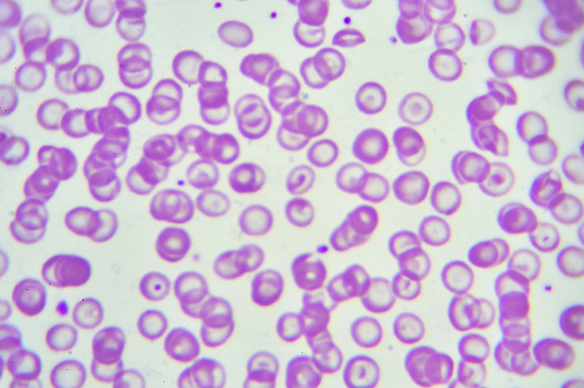 Qué es la talasemia | Familia y Salud