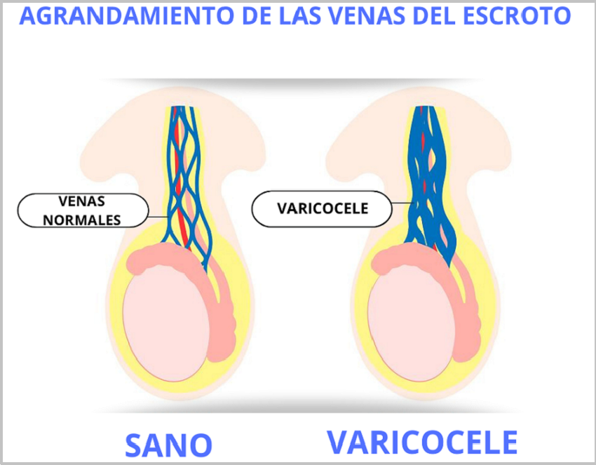 Varicocele | Familia y Salud